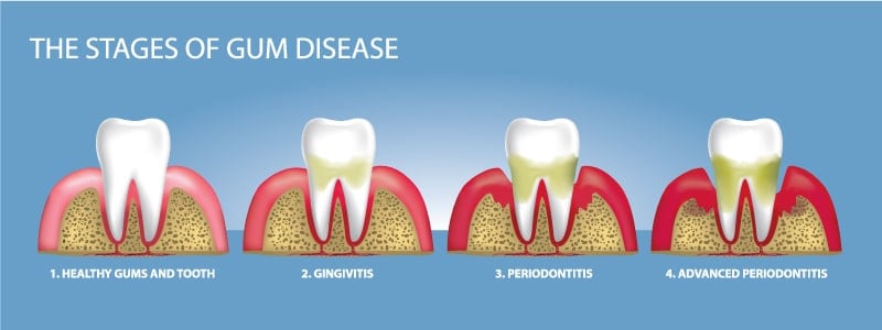 Gum Disease Treatment in Sacramento - The Smile Doctor Sacramento